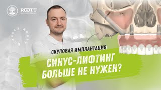 Скуловая имплантация без синус-лифтинга.mp4