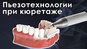 Применение ультразвуковых инструментов для кюретажа