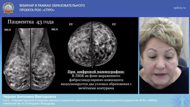 Вебинар "Лучевая диагностика заболеваний молочной железы"
