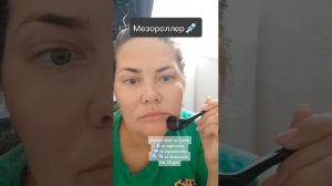 Мезороллер