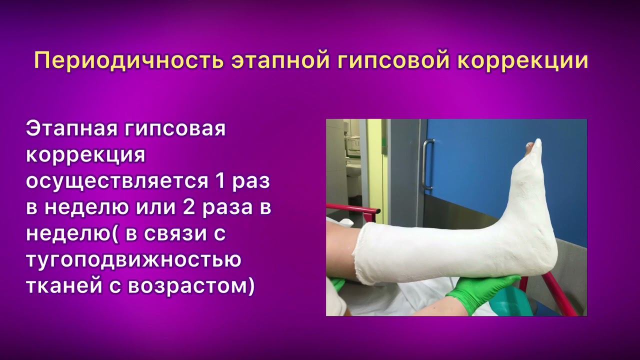 Периодичность этапной гипсовой коррекции