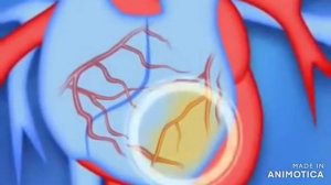 Сердечно сосудистые заболевания(инфаркт и инсульт)