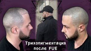 Трихопигментация после пересадки волос FUE. Голова + шрам Scalp Micropigmentation SMP after FUE