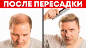Что вас ждёт после пересадки волос | Александр Долгов