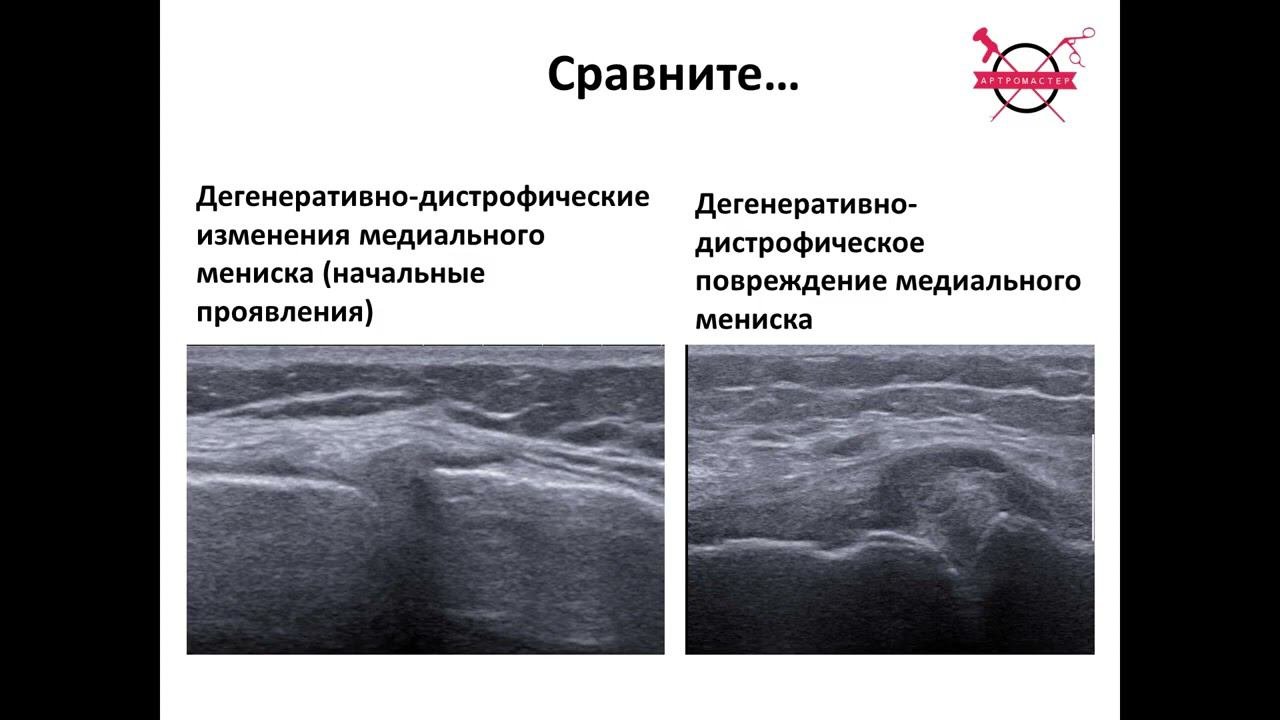 #УЗИ менисков коленного сустава