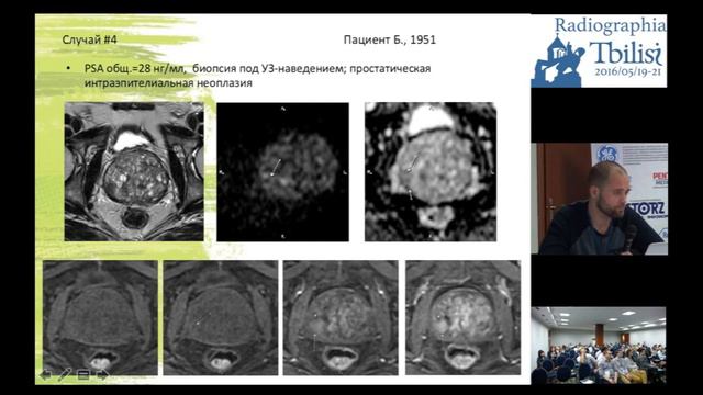 МРТ рака предстательной железы. Клинические случаи