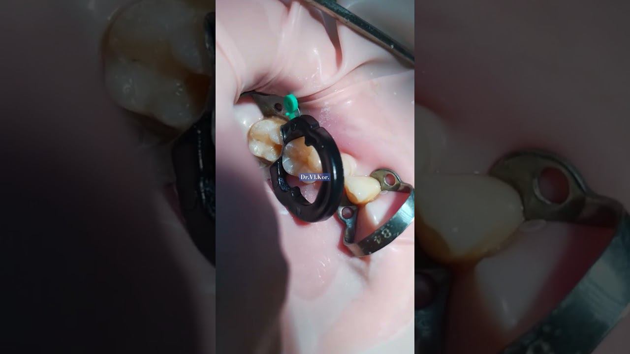 Insert matrix ring Runa dent black.