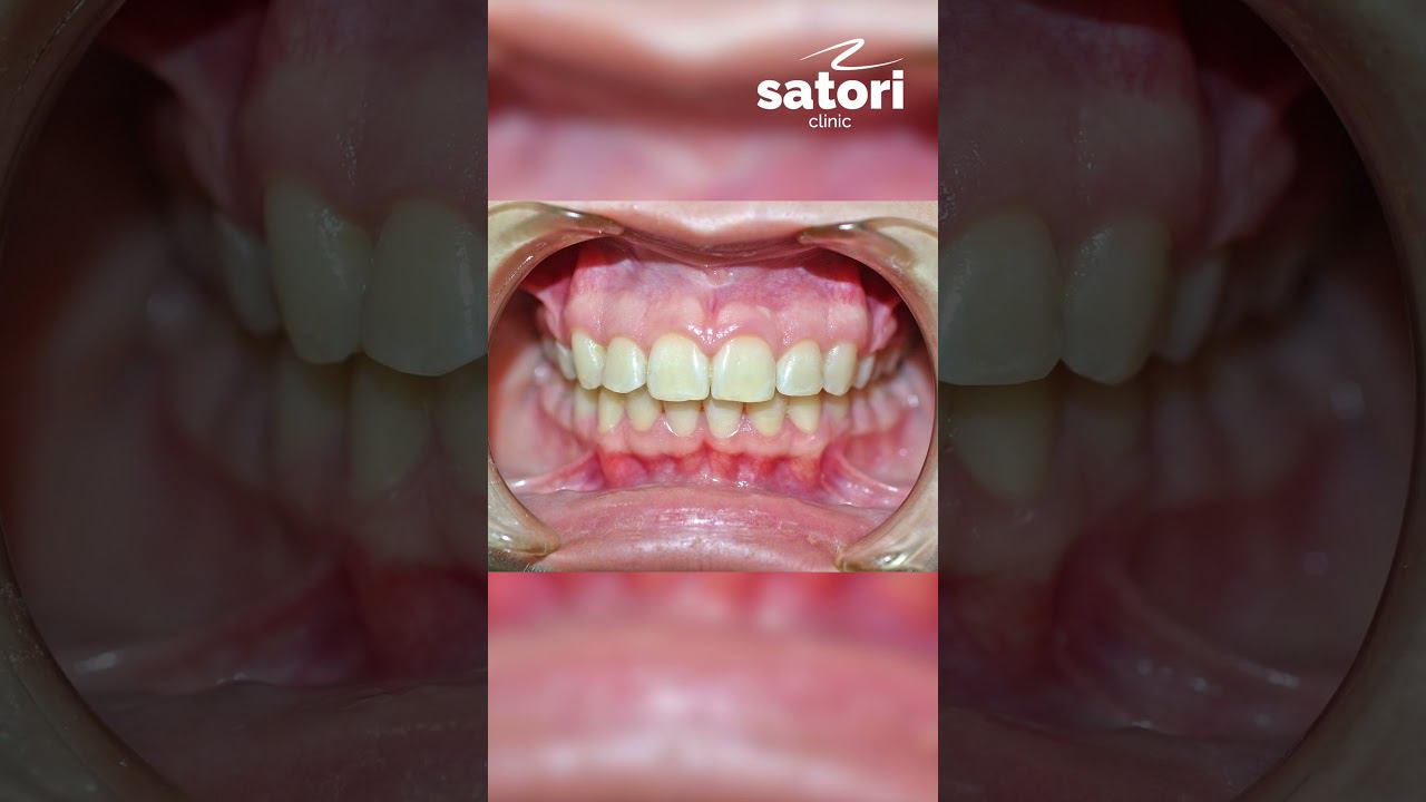 Результат коагуляции десны #зубы #брекеты #braces