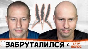 Забруталился! Трихопигментация вместо пересадки волос. Нет облысению Scalp Micropigmentation SMP