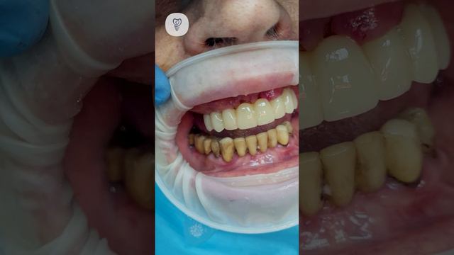 Удалили 11 зубов и установили 4 имплантата плюс временную конструкцию. Имплантация зубов.