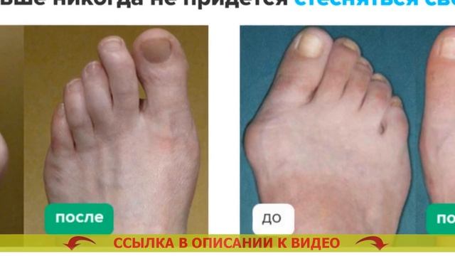 👣 ЛАНГЕТА НА БОЛЬШОЙ ПАЛЕЦ НОГИ 🤕 – смотреть онлайн видео от Загадочное ...