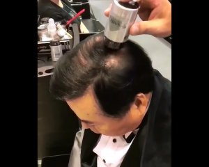 Как избавиться от лысины
