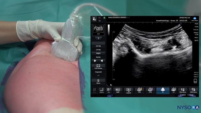 PENG BLOCK FOR HIP PAIN (NYSORA's Regional Anesthesia Clinical Cases)