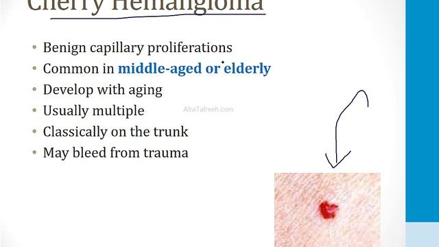 Дерматология USMLE - 1. Общее - 6.Сосудистые поражения