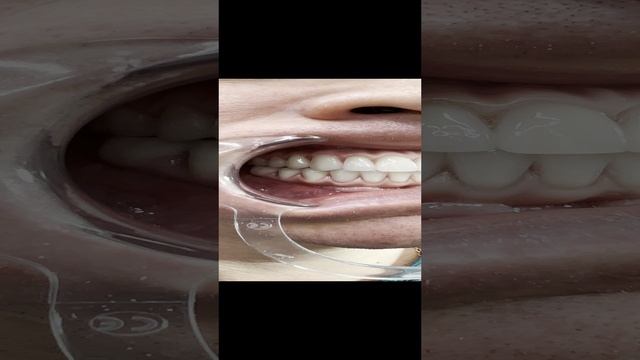 Постоянный керамокомпозитный протез устанавливается сразу и включен в стоимость операции All-On-4