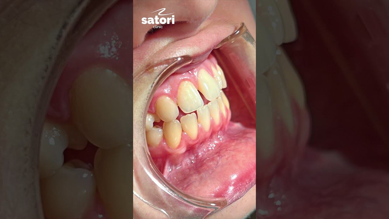 До и после ортодонтического лечения  #брекеты #зубы #брекетысамара