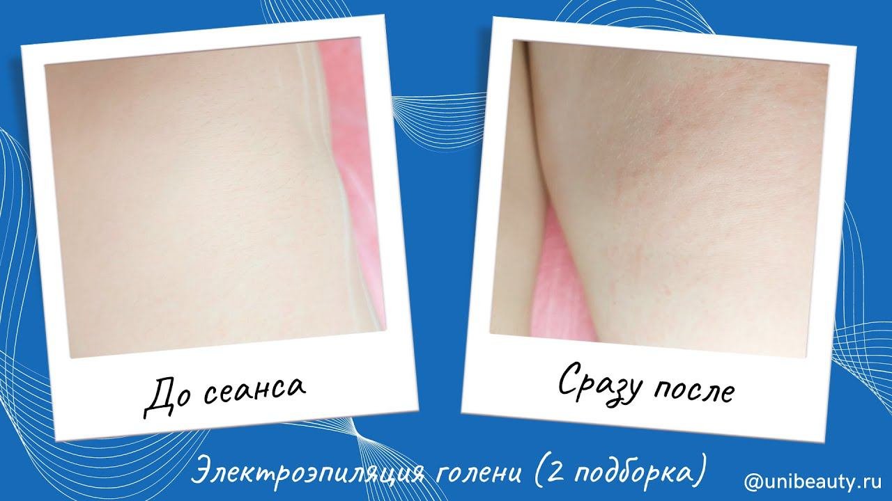Электроэпиляция ног методом blend