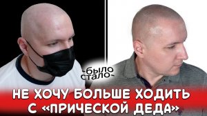 Не хочу больше ходить с прической деда! Трихопигментации при облысении лучше чем пересадка волос SMP