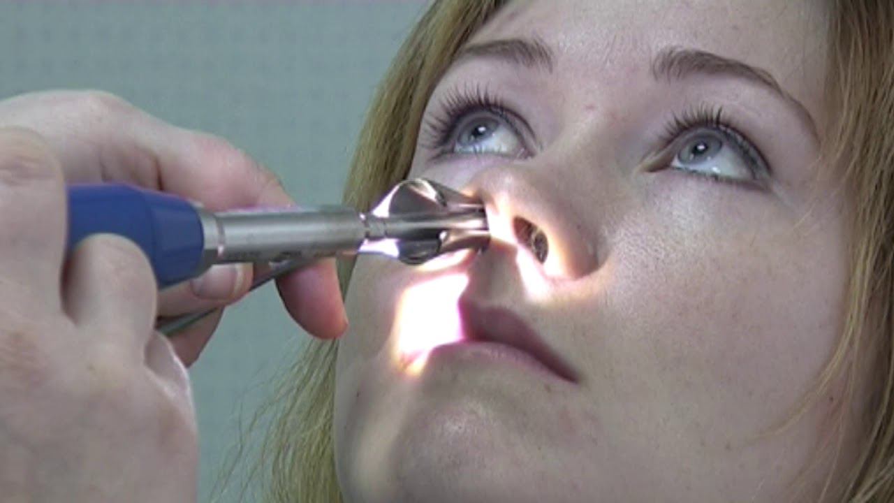 Ultrasonic cavitation system "ACTITON" in ENT