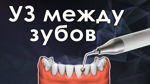 Применение ультразвука в интерпроксимальных областях