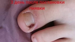 Работа пиявки. Панариций. Нижегородский Костоправ 89870878785