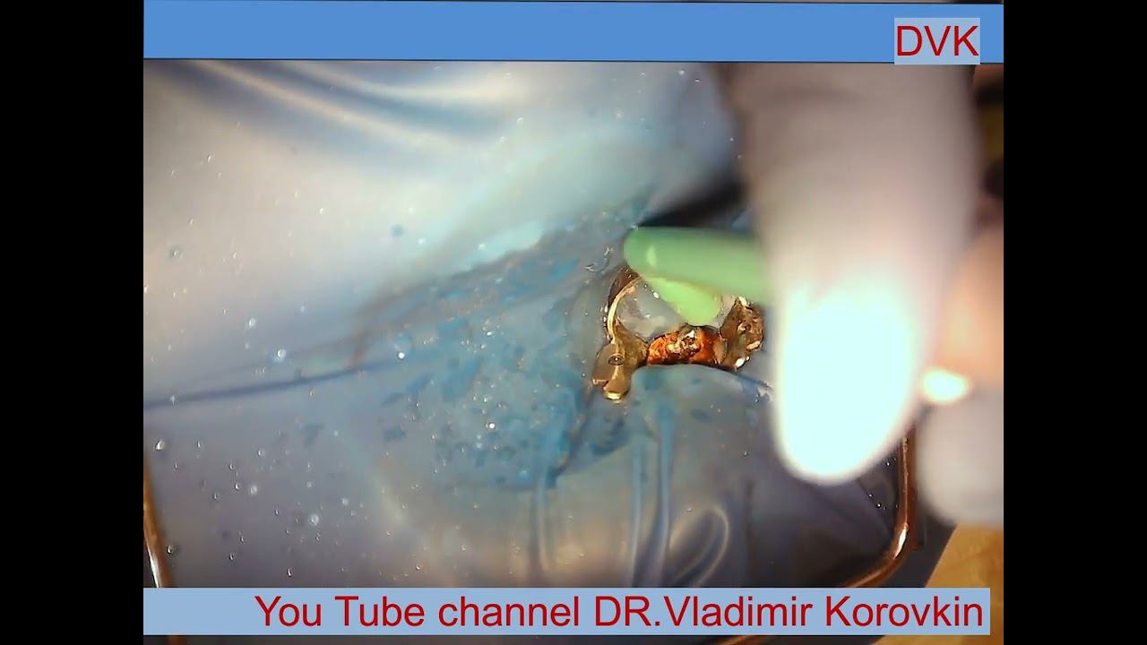 Removal of the stump of an intra-root tab. Video speed 2x.#removal