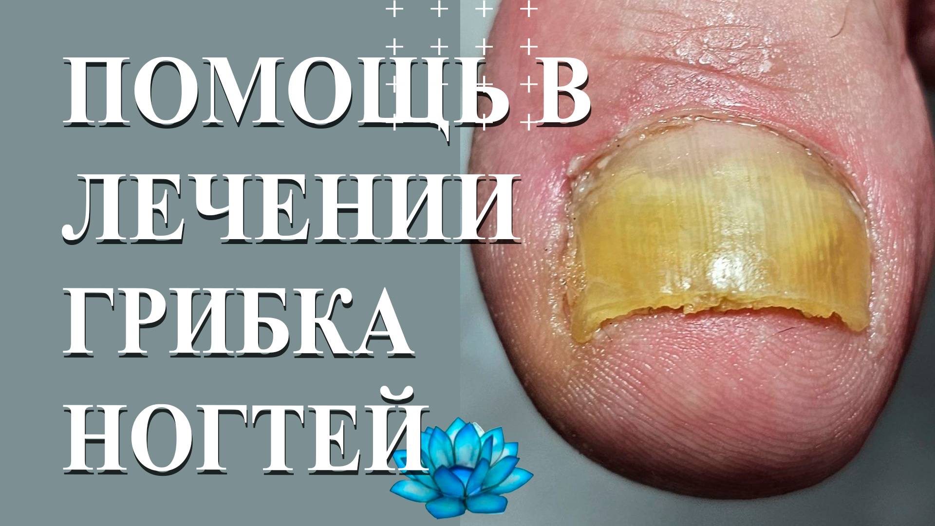 Как помочь клиенту вылечить грибок ногтей на ногах.