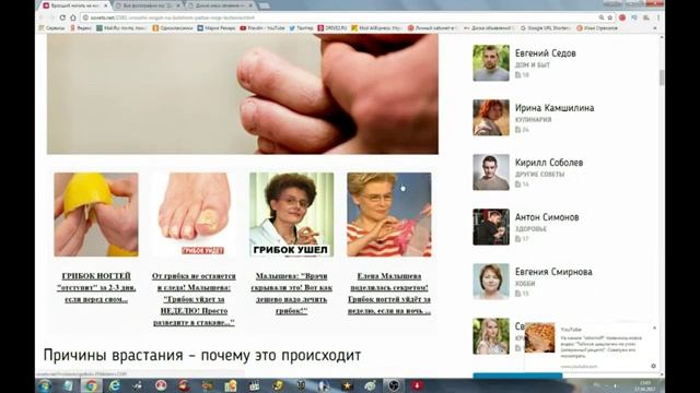 Лечение Вросшего Ногтя Без Операции За 3 Дня. Убираем дикое мясо без боли.