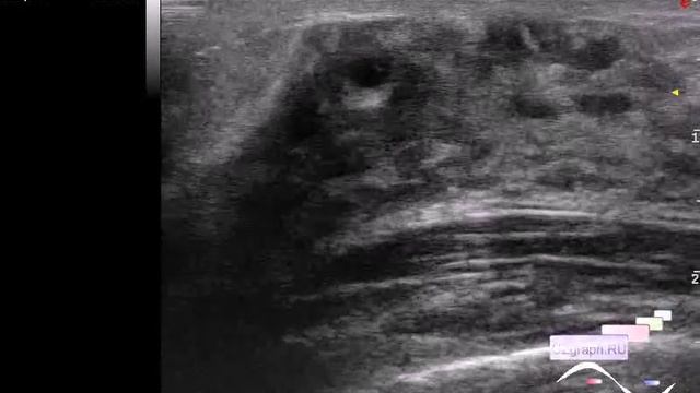 УЗИ молочных желез - Кисты молочных желез