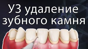 Пескоструйная чистка зубов
