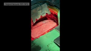 мамарокоронарне шунтування 2