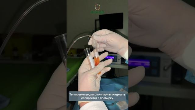Как проходит пункция фолликулов в клинике Ankalife.
