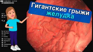 Гигантские грыжи желудка | Клинический случай