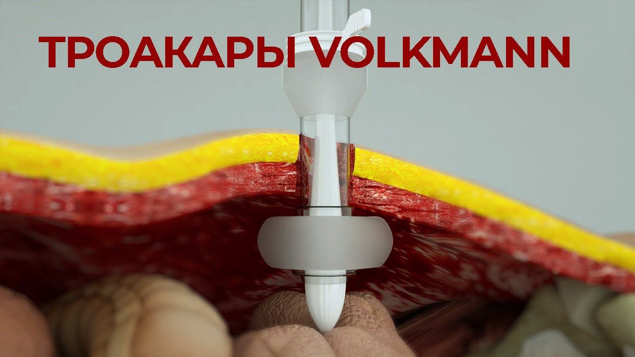 Троакары Volkmann