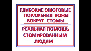СТОМЫ С ГЛУБОКИМ ОЖОГОВЫМ ПОРАЖЕНИЕМ КОЖИ.STOMAS WITH A DEEP BURN LESION OF THE .mp4