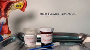 Применение зондов тип Н2 при проведении расширенное кольпоскопии.