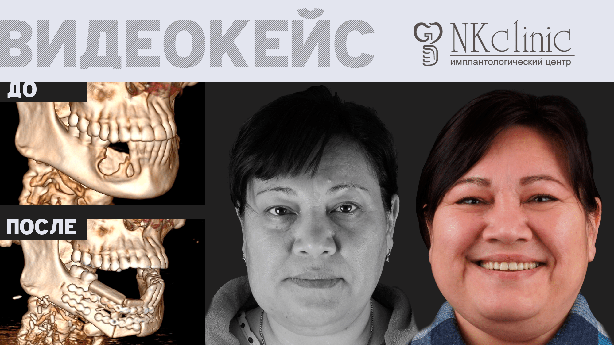 Удаление амелобластомы нижней челюсти справа