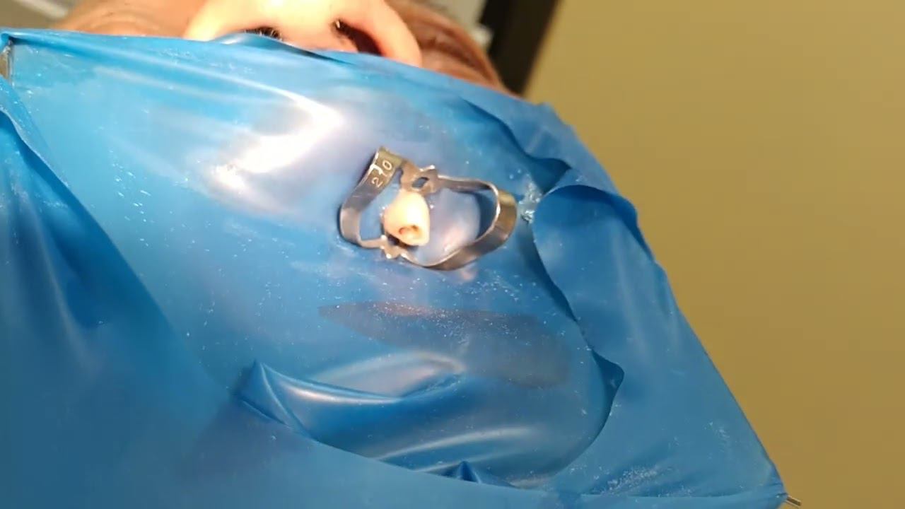 AO BO SI case. 23 изоляция.Кламп 210 в обратной позиции.