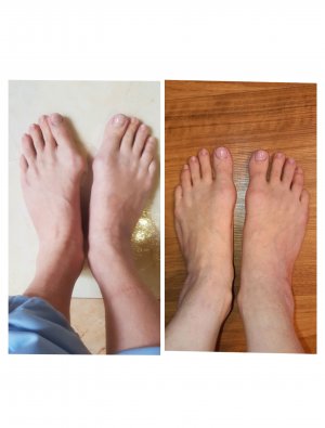 Халюс Вальгус. Hallux valgus Снятие швов.mp4