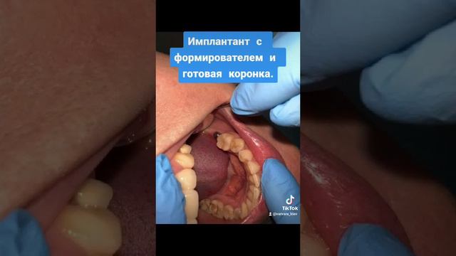 Формирователь десны ,как выглядит?Циркониевая коронка на винте на имплантанте