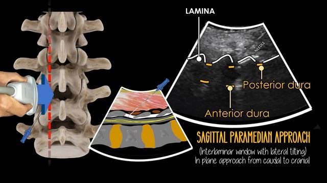Эпидуральная блокада и люмбальная пункция (ULTRASOUND GUIDED LUMBAR EPIDURAL INFILTRATION)