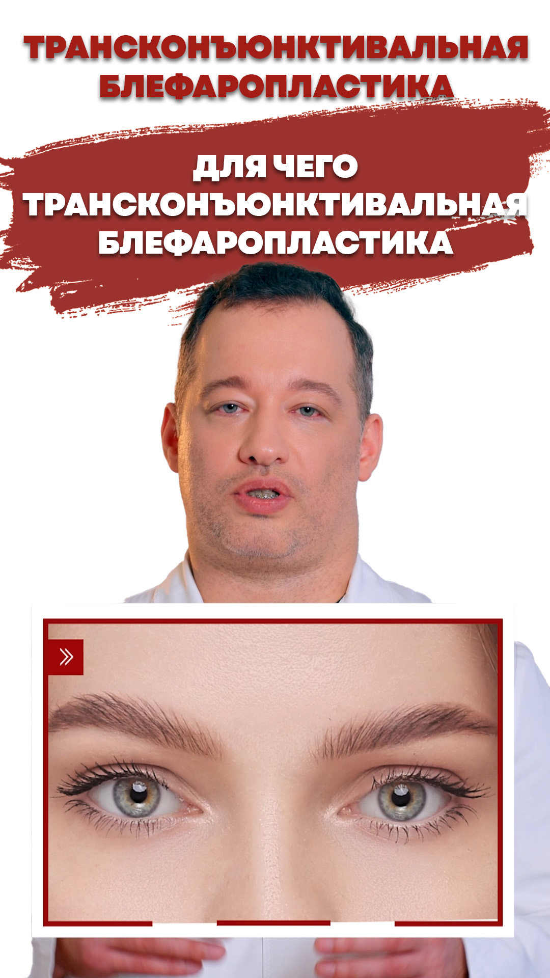Для чего трансконъюктивальная блефаропластика