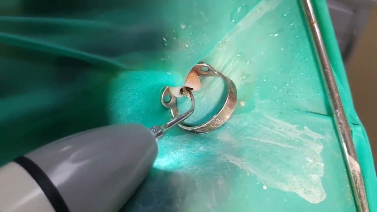 Removing the endocanal brass pin in the 24th tooth.
