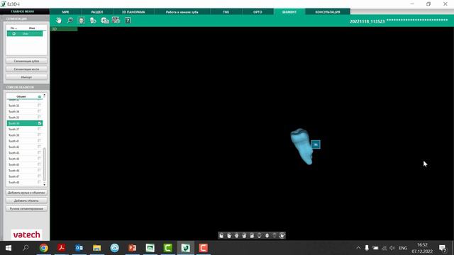 Сегментация и планирование имплантата