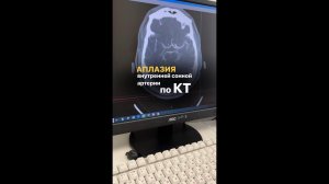 Аплазия внутренней сонной артерии на КТ