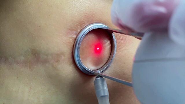 Удаление Шрама Фракционным Лазером