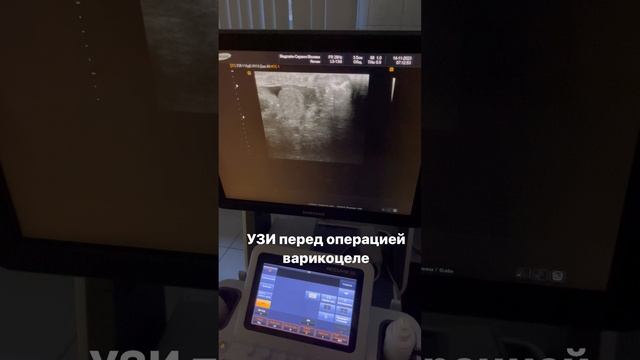 Варикоцеле. Узи вен малого таза. Урология. Флеболог Москва. Флеболог
