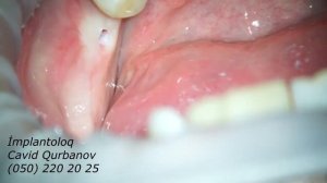 Имплантация зубов в Баку - Bakıda diş implantasiyası - Dental implantation in Azerbaijan MEDHOLDINGИ