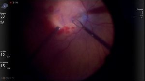 Операция: сквозное макулярное отверстие. Operation: through macular hole