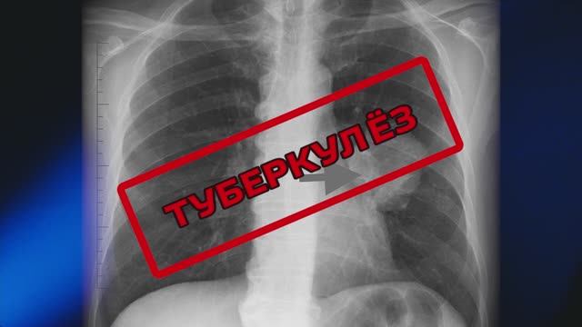 О ТУБЕРКУЛЁЗЕ